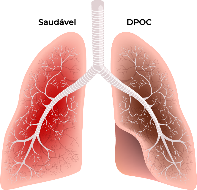 Fisiopatologia da DPOC e cascata inflamatória